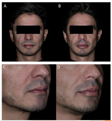 Men lips enhancement: new customized approach for male’s lip treatments ...