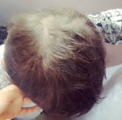 Cutaneous manifestations of pediatric Systemic Lupus Erythematosus ...