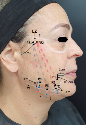 A novel technique for repositioning facial soft tissues with barbed ...