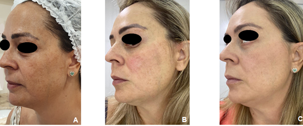 A novel technique for repositioning facial soft tissues with barbed ...