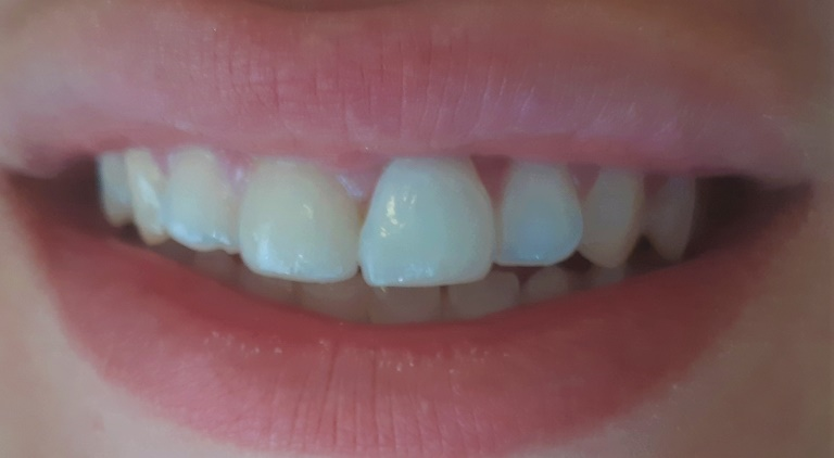 Success tips for renewing fractured ceramic veneer on central insicor ...
