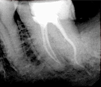 Redefining the new generation endodonticsGenEndo Files: cases reports ...