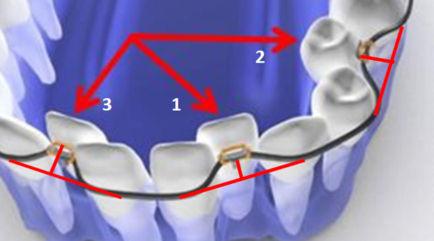 A new orthodontic diagnosis based on the cupping depth of the alveolar ...