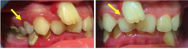 A new orthodontic diagnosis based on the cupping depth of the alveolar ...