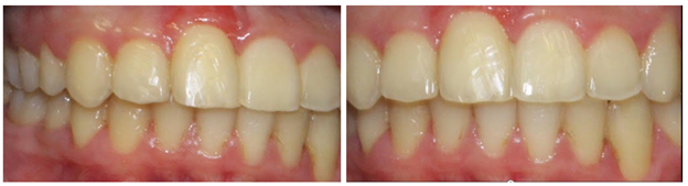 A new orthodontic diagnosis based on the cupping depth of the alveolar ...