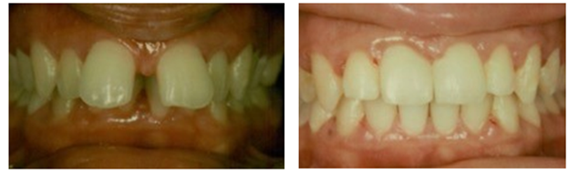 A new orthodontic diagnosis based on the cupping depth of the alveolar ...