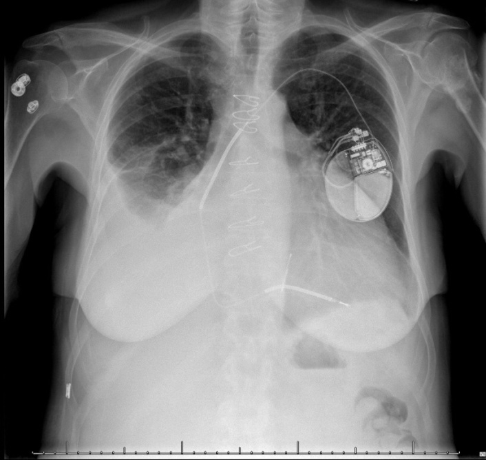 A Case of hydropneumothorax - MedCrave online