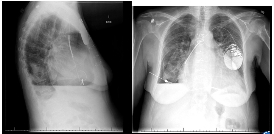 A Case of hydropneumothorax - MedCrave online