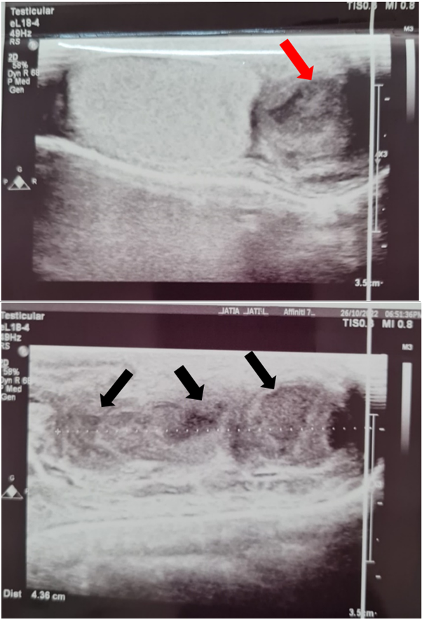 Unilateral epididymal tuberculosis with scrotal fistula: a case report ...