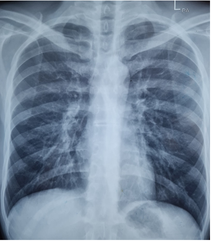 Unilateral epididymal tuberculosis with scrotal fistula: a case report ...