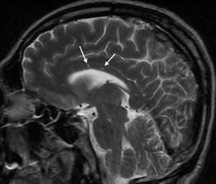 Cases of Susac syndrome misdiagnosed with multiple sclerosis - MedCrave ...