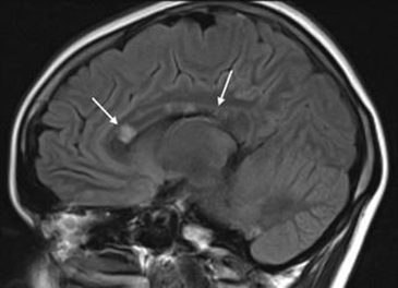 Cases of Susac syndrome misdiagnosed with multiple sclerosis - MedCrave ...