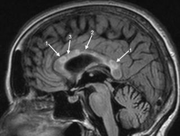 Cases of Susac syndrome misdiagnosed with multiple sclerosis - MedCrave ...