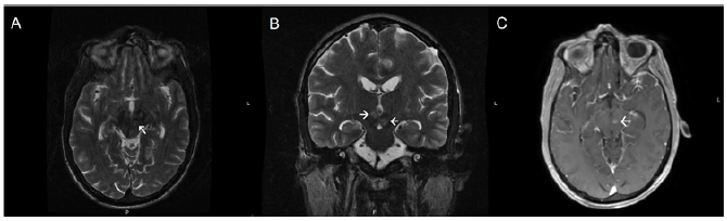 Beware of cryptococcomas when treating Cryptococcal meningitis ...