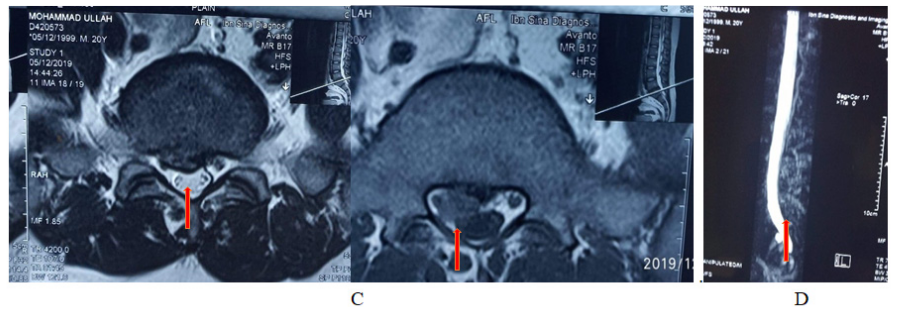 Spinal epidural varicosity resembling prolapsed intervertebral disc on ...