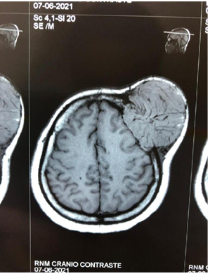 Case report: left frontal extra axial tumor caused by epithelial ...