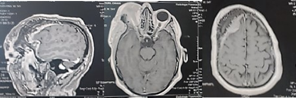 Frontotemporal intradiploic meningioma with progressive intraorbital ...