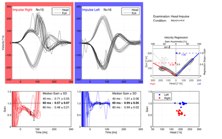 Video head impulse test finding in vestibular lesions - MedCrave online