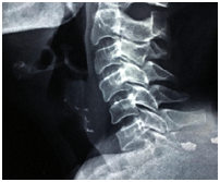 Foreign body: denture in oesophagus: a case report - MedCrave online