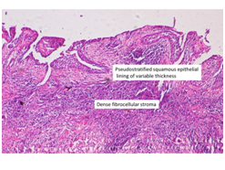 Sinus augmentation with simultaneous removal of antral polyp - MedCrave ...