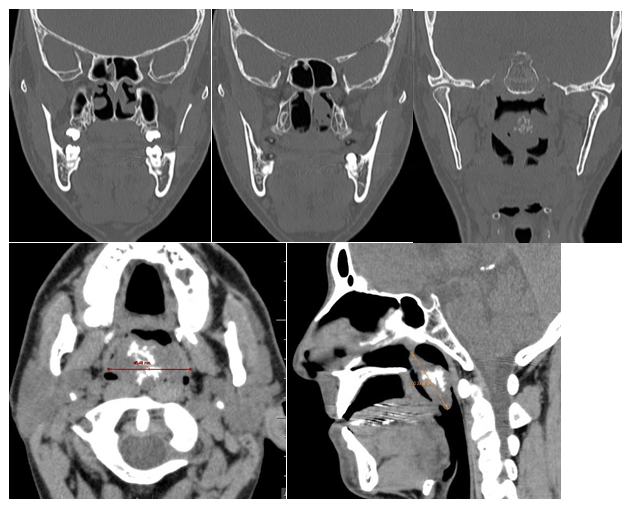 Nasal obstruction due to septochoanal polyp with bone metaplasia: Case ...