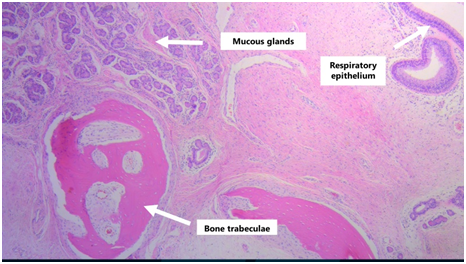 Nasal obstruction due to septochoanal polyp with bone metaplasia: Case ...