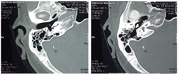 Deceiving & deceptive growth in the ear canal in an elderly female ...