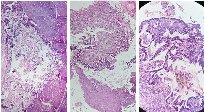Deceiving & deceptive growth in the ear canal in an elderly female ...