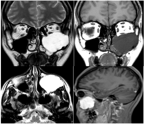 Infraorbitary artery epistaxis - MedCrave online