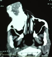 Giant osteoma of the maxillary sinus: a case report - MedCrave online
