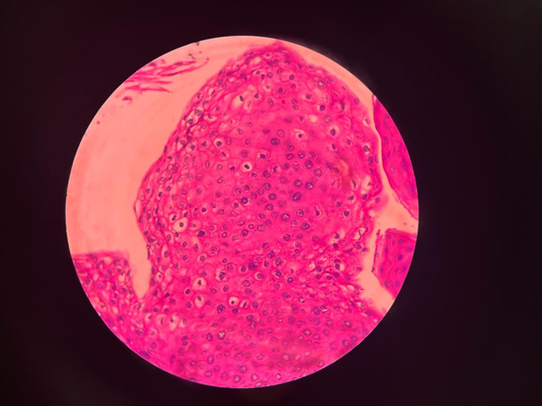 Laryngeal papillomatosis in an adult patient: managed with ...