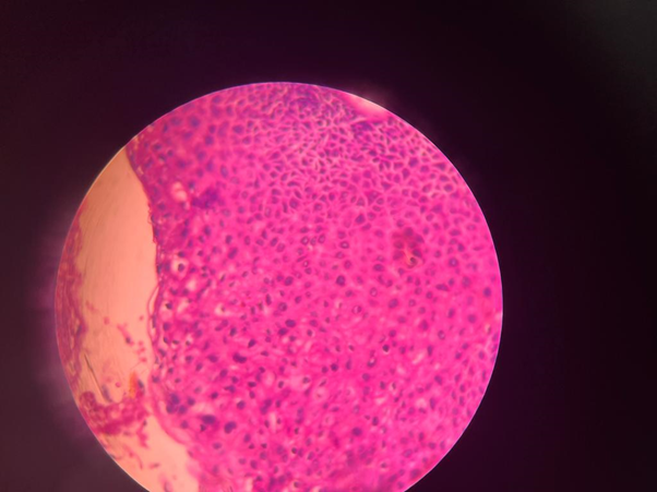 Laryngeal papillomatosis in an adult patient: managed with ...