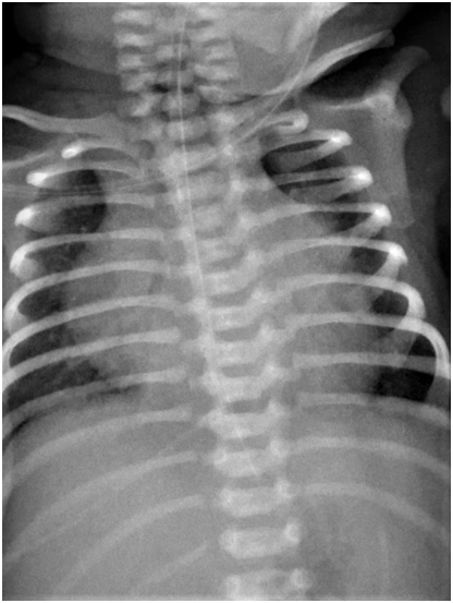 A case of neonatal lupus erythematosus with multiorgan involvement and ...