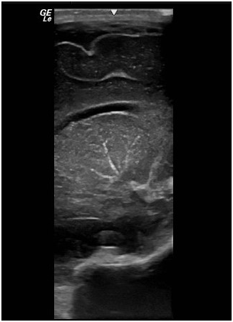 A case of neonatal lupus erythematosus with multiorgan involvement and ...