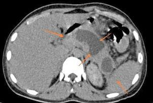 A rare case of unusual presentation of acute necrotising pancreatitis ...