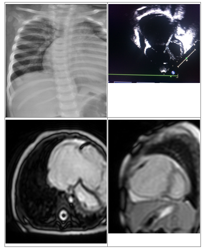 Uhl’s anomaly: A rare form of congestive cardiac failure in early ...