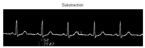Analysis on conversion process from paper record ECG to computer based ...