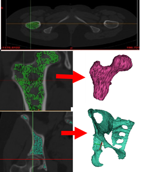 Application of the finite element model using 3D modeling of a human ...