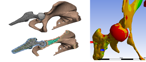 Application of the finite element model using 3D modeling of a human ...