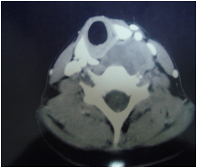 Aggressive Fibromatosis of the Neck: A Case Report and Review of the ...