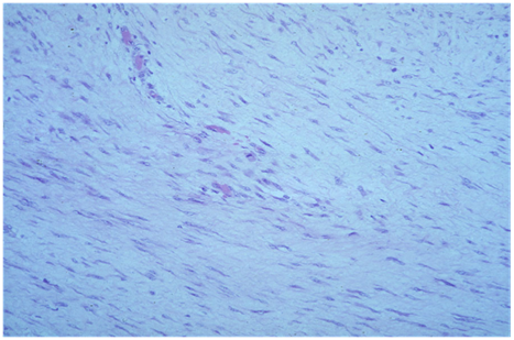 Aggressive Fibromatosis of the Neck: A Case Report and Review of the ...