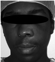 Large maxillary adenomatoid odontogenic tumor: case report - MedCrave ...