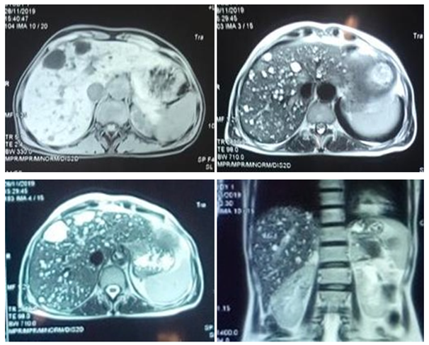 Diffuse oligosymptomatic caroli's disease: case report - MedCrave online