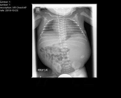 Smith–magenis syndrome. A unique neonatal presentation among the Arab ...