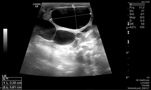 Smith–magenis syndrome. A unique neonatal presentation among the Arab ...