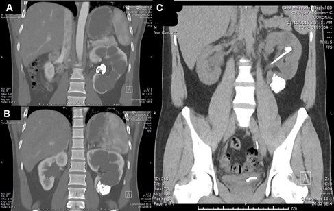Robot-assisted partial nephrectomy and nephrolithotomy for multiple ...
