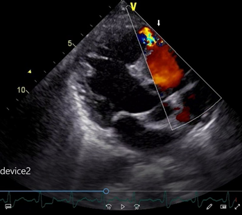 A novice’s approach to a ventricular septal rupture closure with an ...