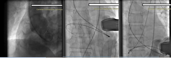 A novice’s approach to a ventricular septal rupture closure with an ...