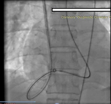A novice’s approach to a ventricular septal rupture closure with an ...