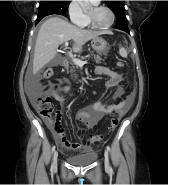 Diagnostic challenges in gastric adenocarcinoma: a case report ...